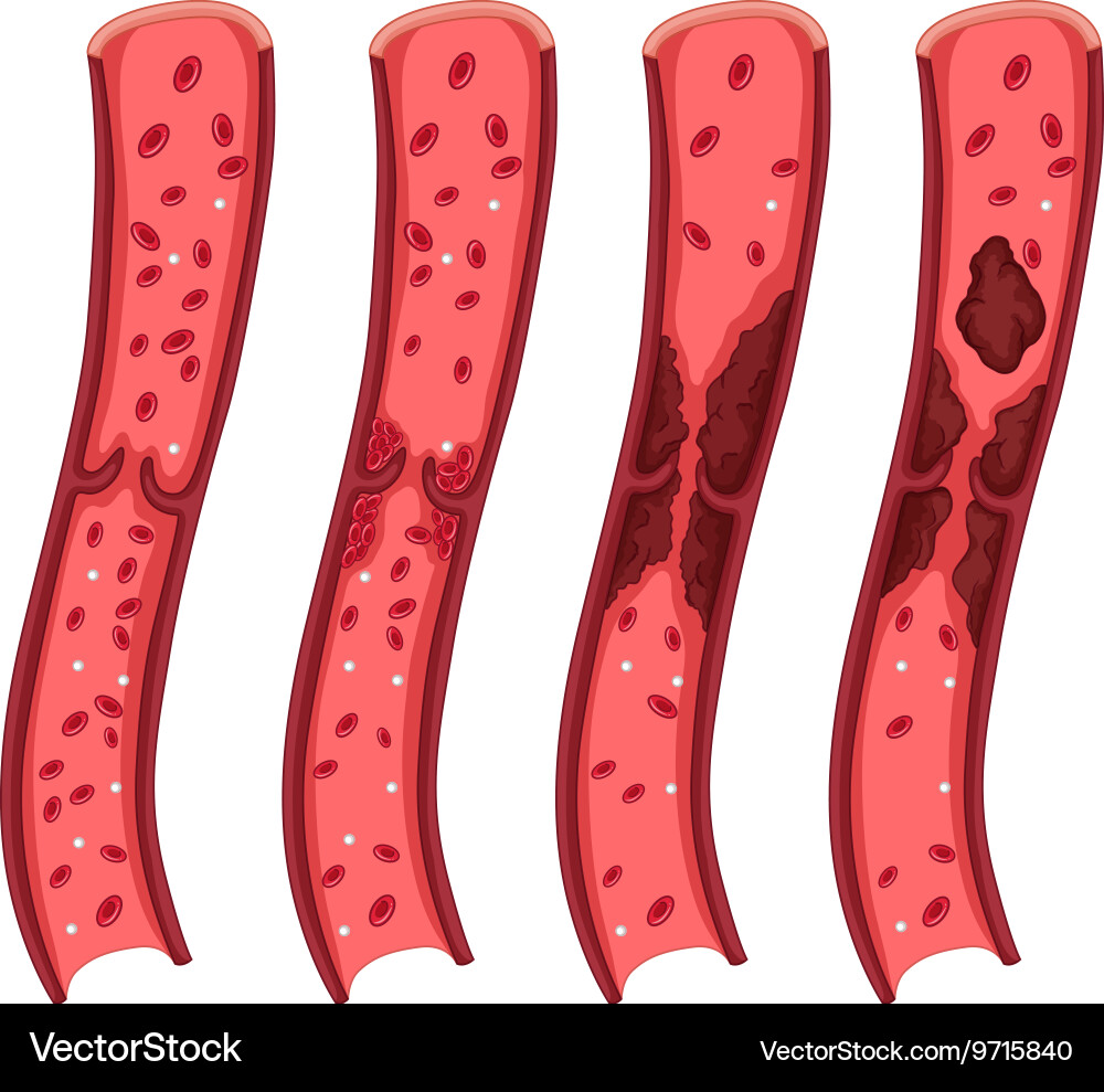 Blood clot diagram on white Royalty Free Vector Image