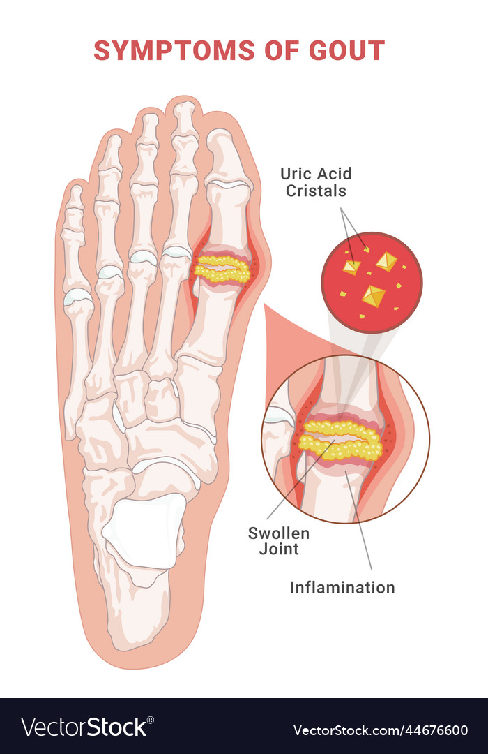 Symptoms of gout infographic scheme flat Vector Image