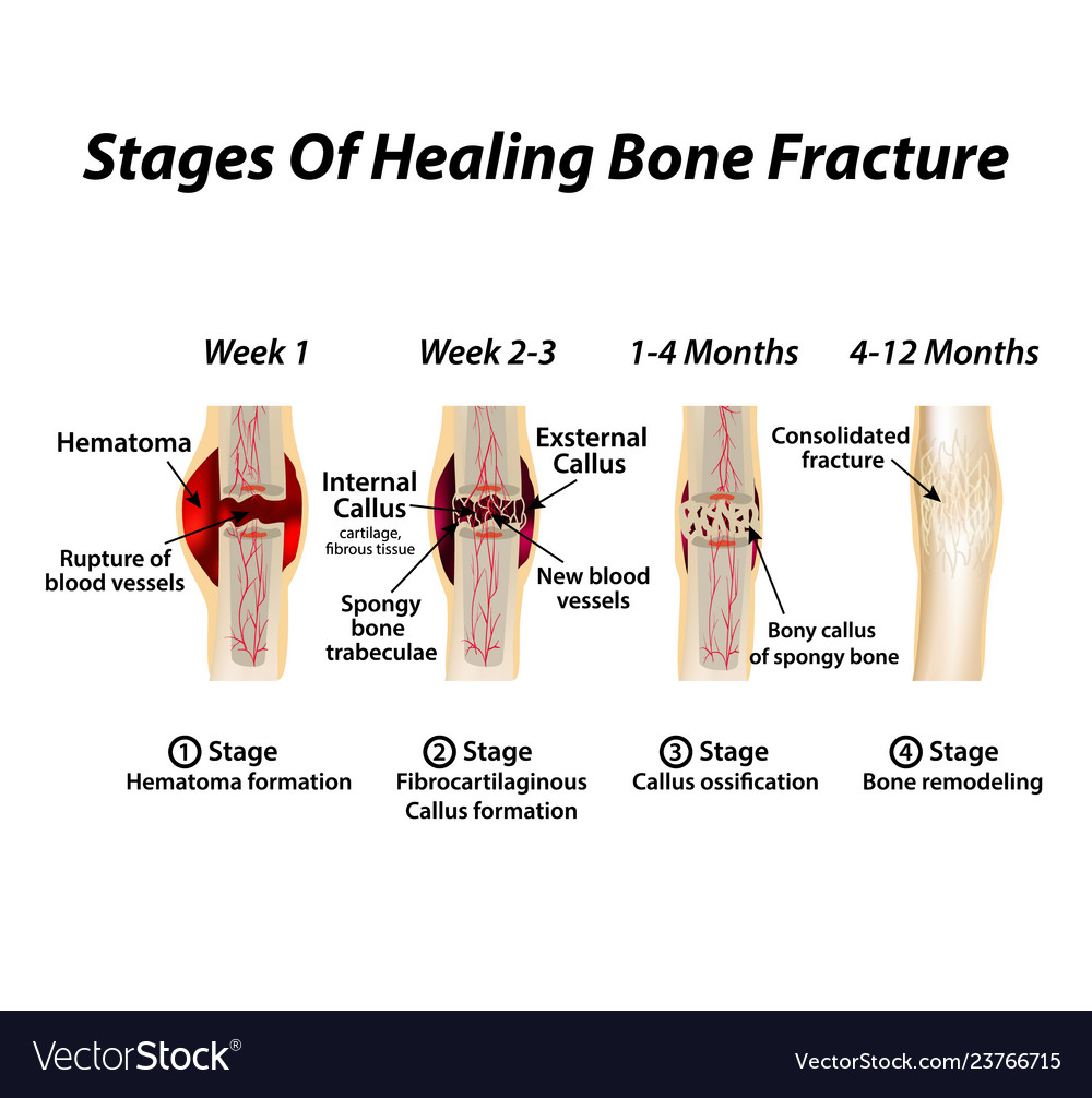 Stages healing bone fracture formation of Vector Image