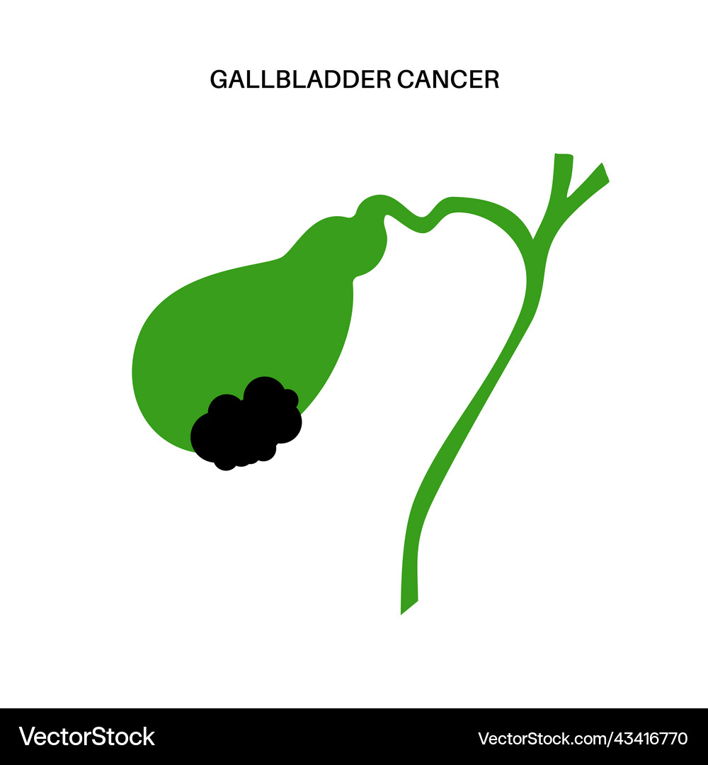 Gallbladder cancer anatomy Royalty Free Vector Image