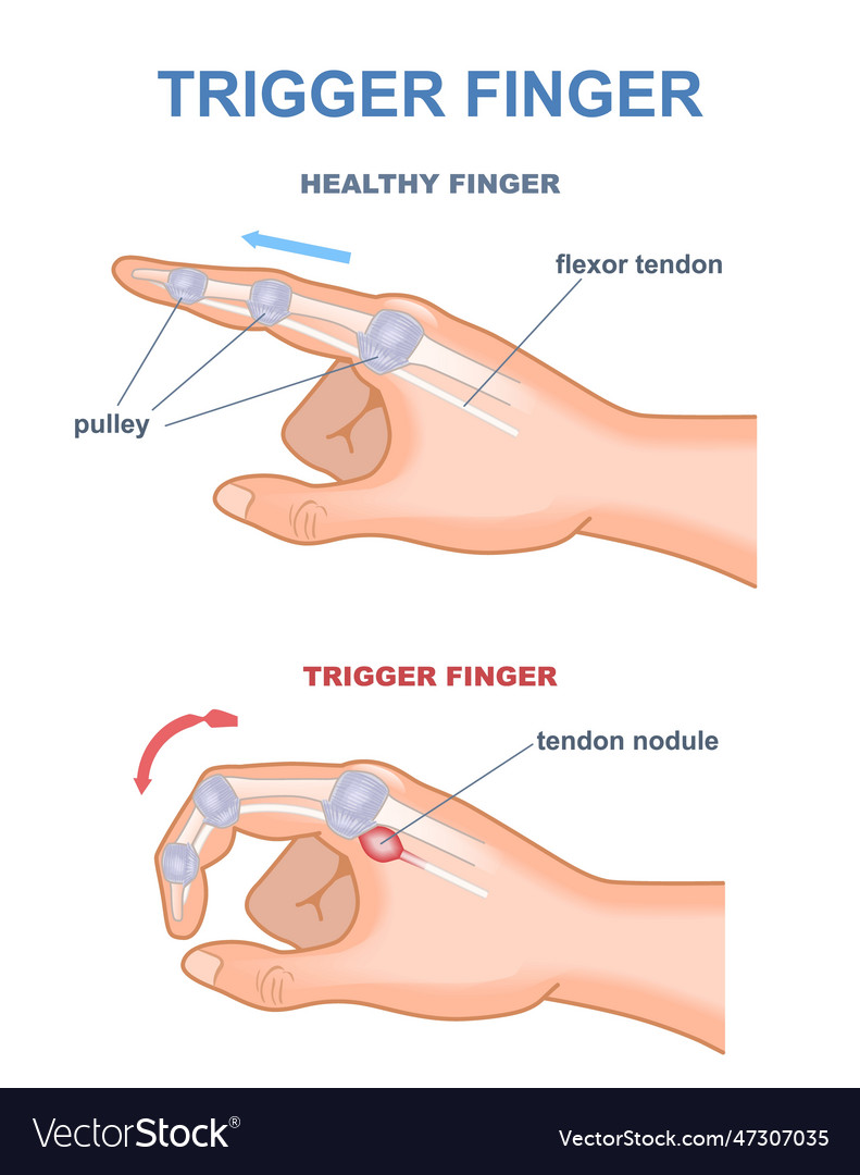Trigger Finger Anatomy Diagram Royalty Free Vector Image