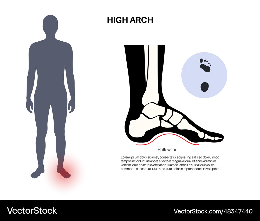 Hollow feet anatomy Royalty Free Vector Image - VectorStock