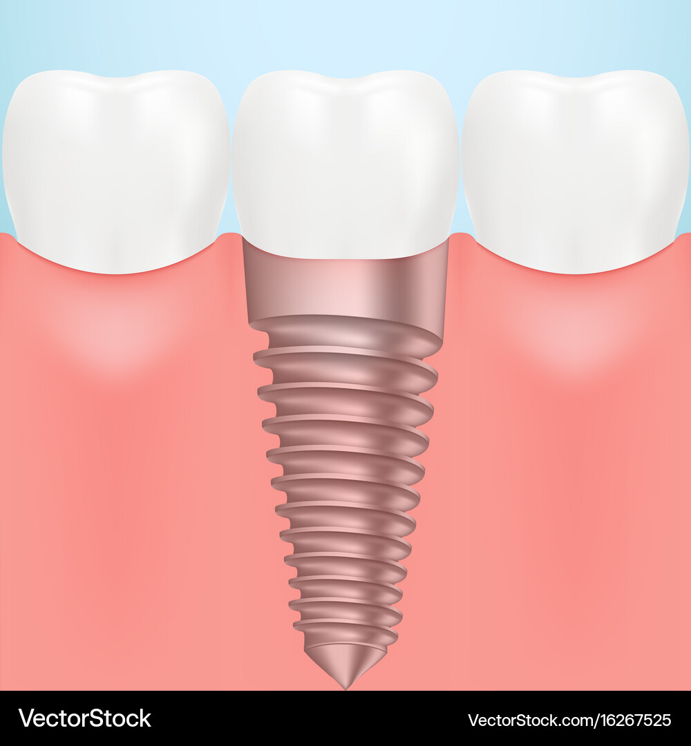 Tooth human implant isolated on a background Vector Image