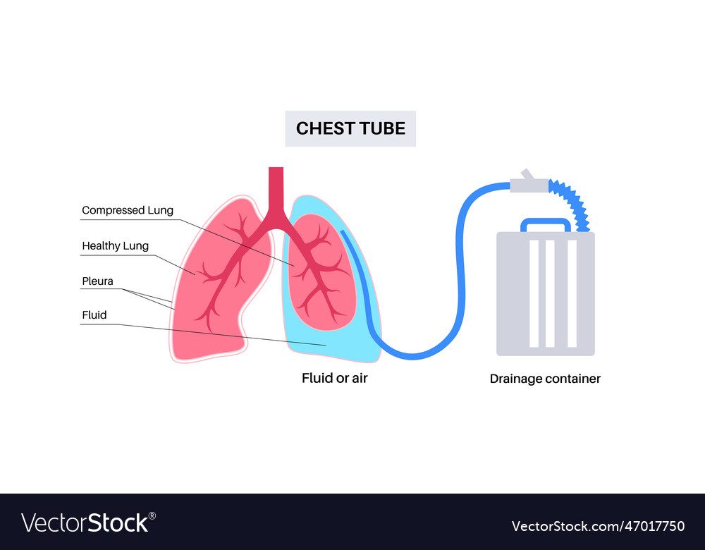 Chest Tube Catheter Royalty Free Vector Image Vectorstock