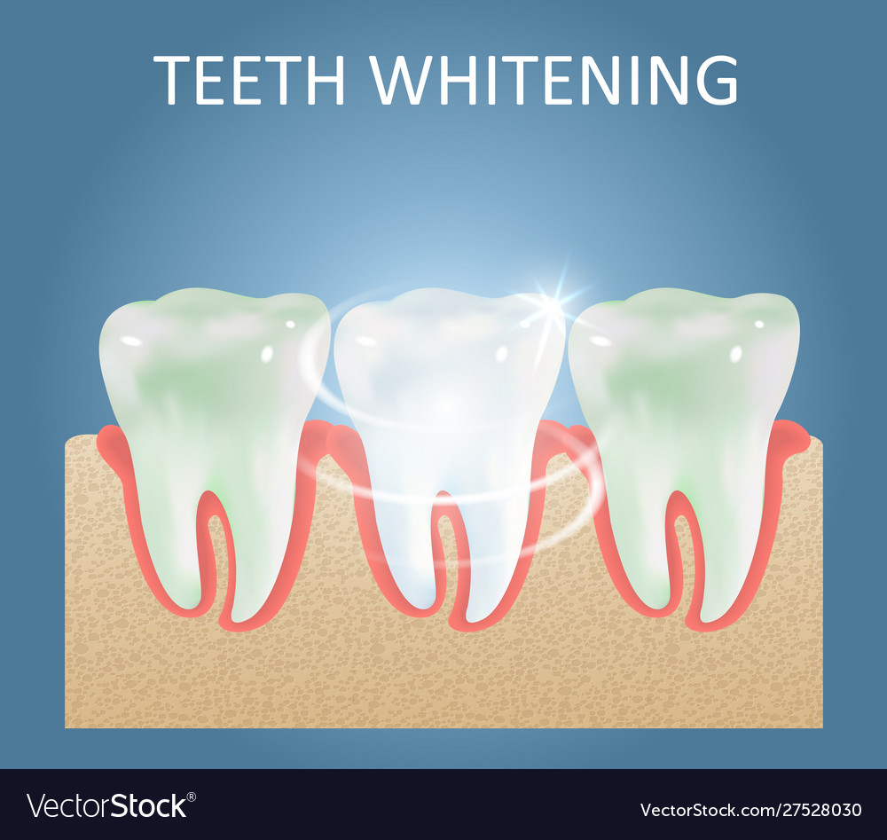 Teeth whitening medical poster design Royalty Free Vector