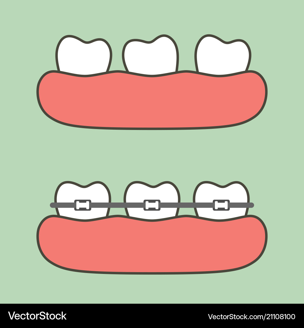 Step of orthodontics treatment Royalty Free Vector Image