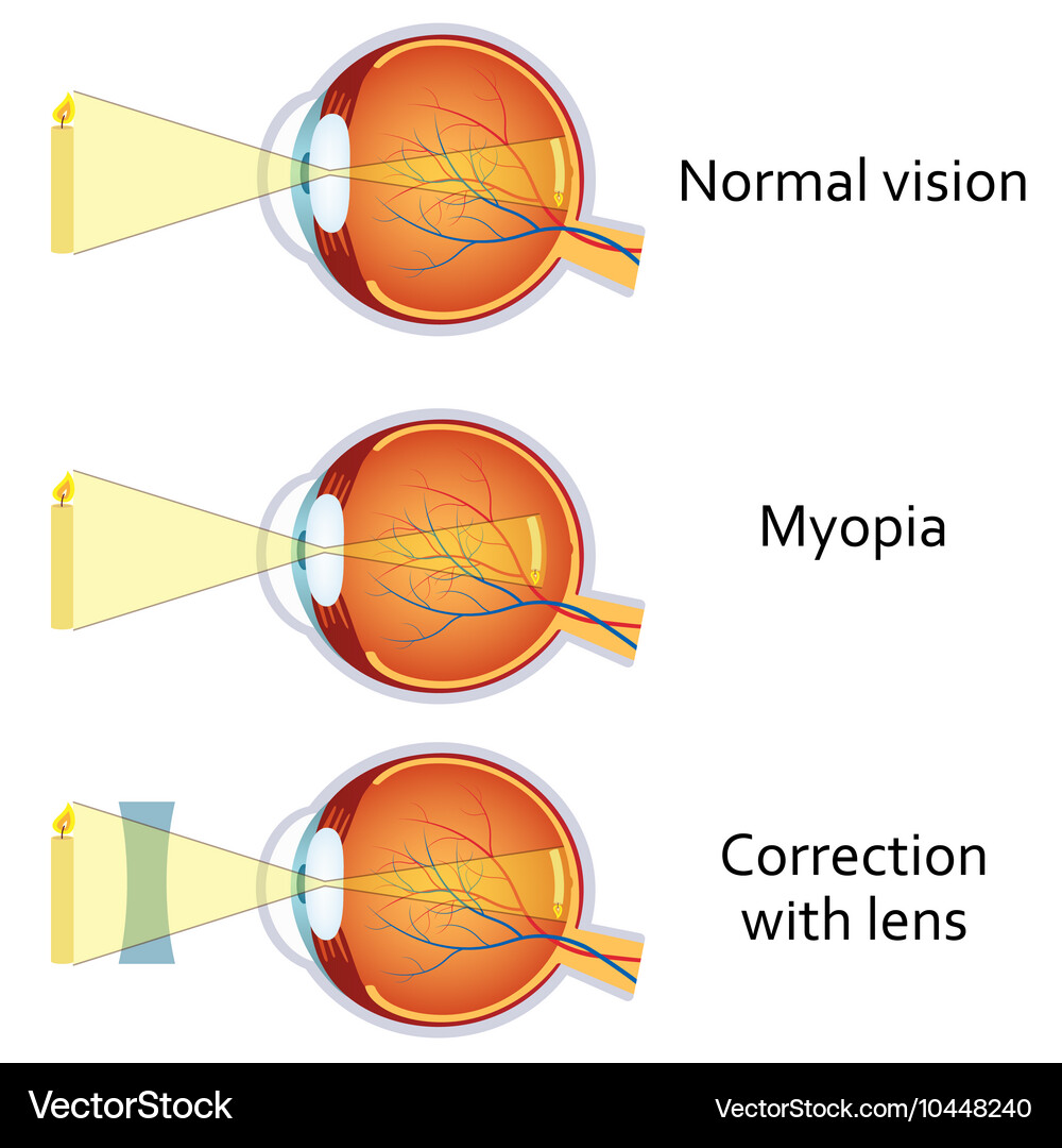 Myopia and myopia corrected by a minus lens Vector Image