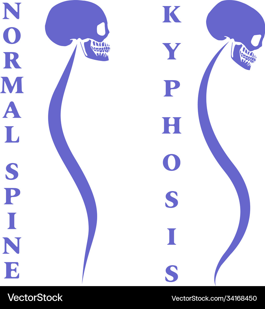 Disease a spine kyphosis Royalty Free Vector Image