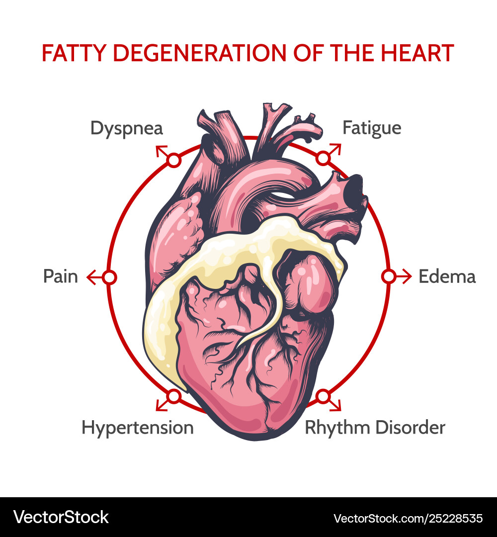 Fatty degeneration heart symptoms Royalty Free Vector Image