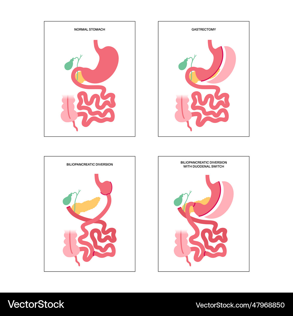 Bariatric Surgery Anatomy Royalty Free Vector Image