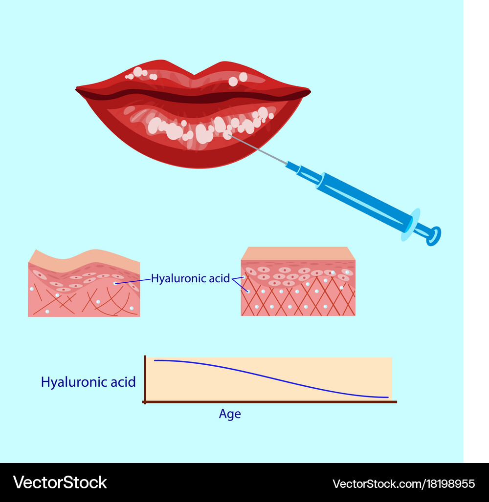 Hyaluronic acid injectionlips procedure Royalty Free Vector