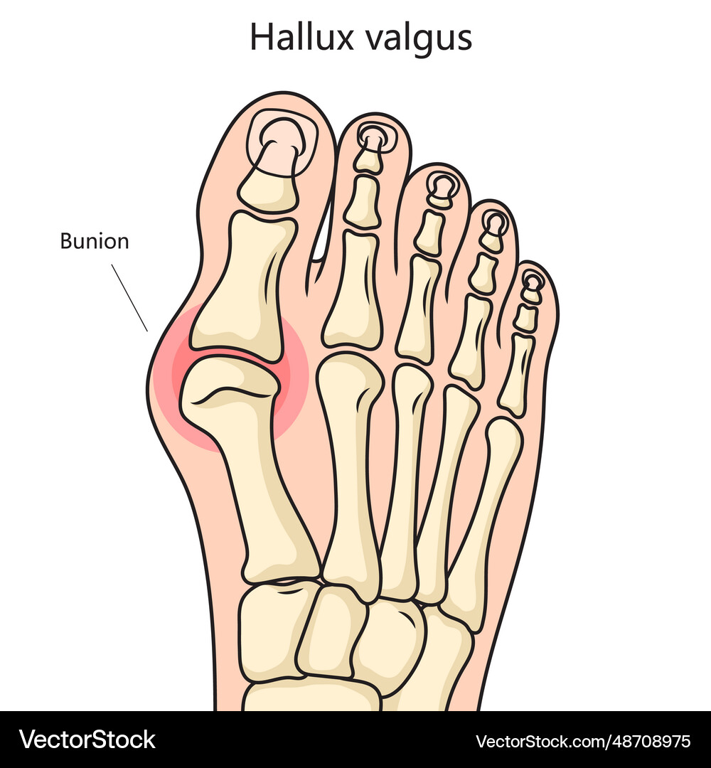 Hallux valgus structure diagram medical science Vector Image