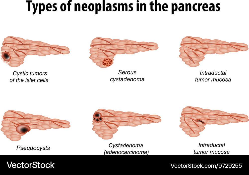 Types neoplasms in pancreas infographics Vector Image
