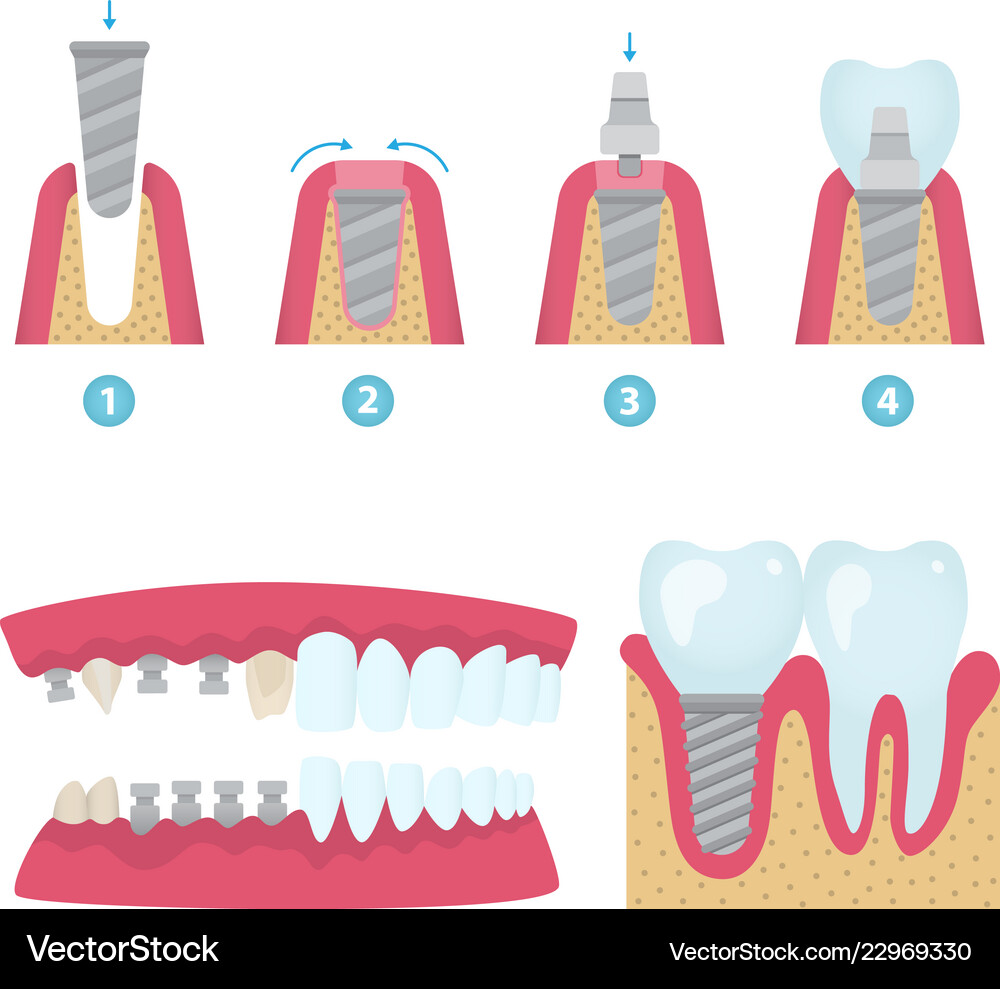 Dental crowns and implantation Royalty Free Vector Image