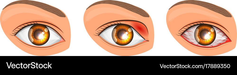 Eye suffering from conjunctivitis and styes Vector Image
