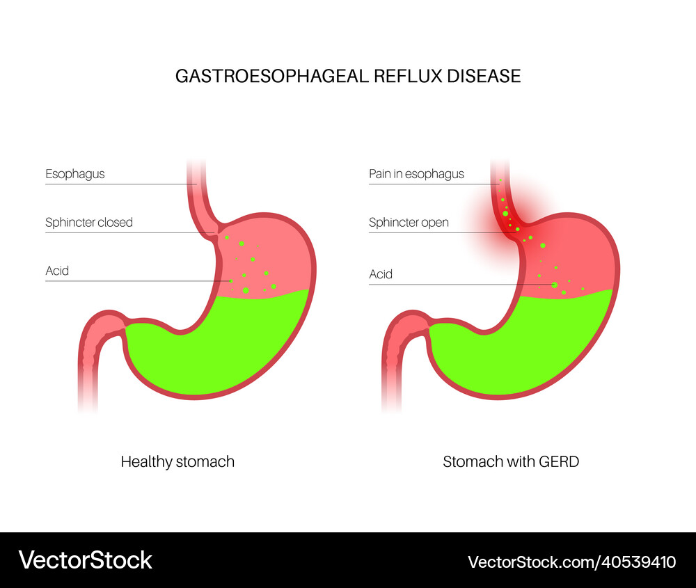 Gastroesophageal Reflux Disease (GERD) Royalty Free Vector