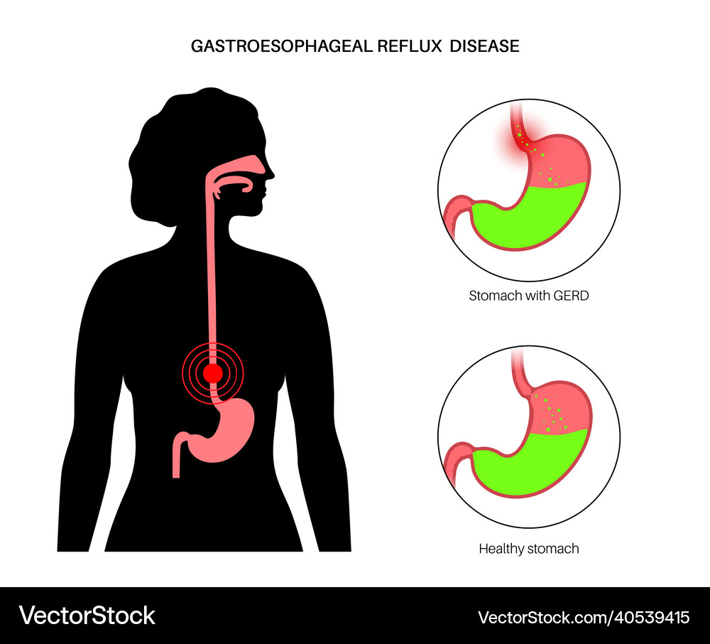 Gastroesophageal reflux disease Royalty Free Vector Image