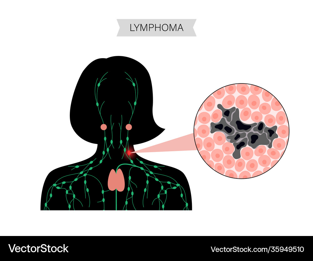 Lymphoma cancer concept Royalty Free Vector Image