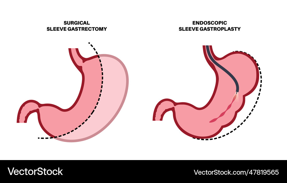 Gastrectomy and gastroplasty Royalty Free Vector Image
