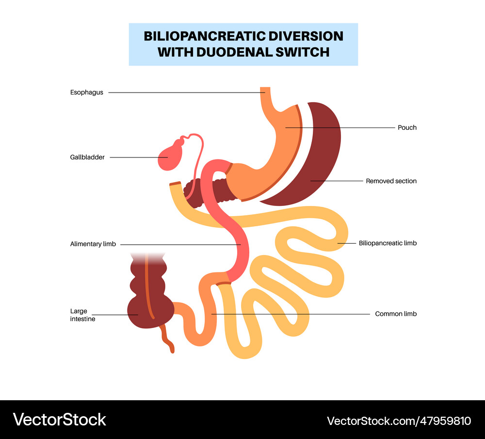 Biliopancreatic diversion procedure Royalty Free Vector