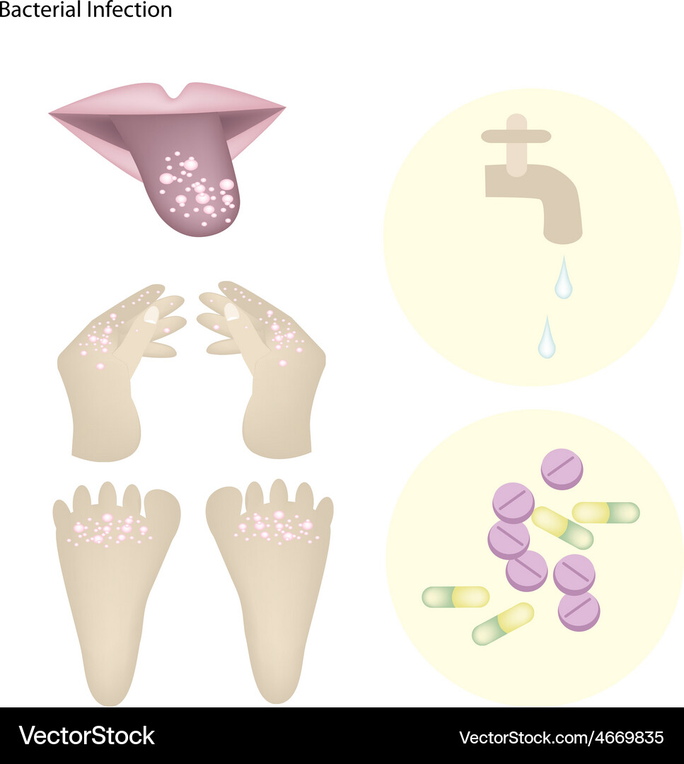 Bacterial infection with prevention and treatment Vector Image