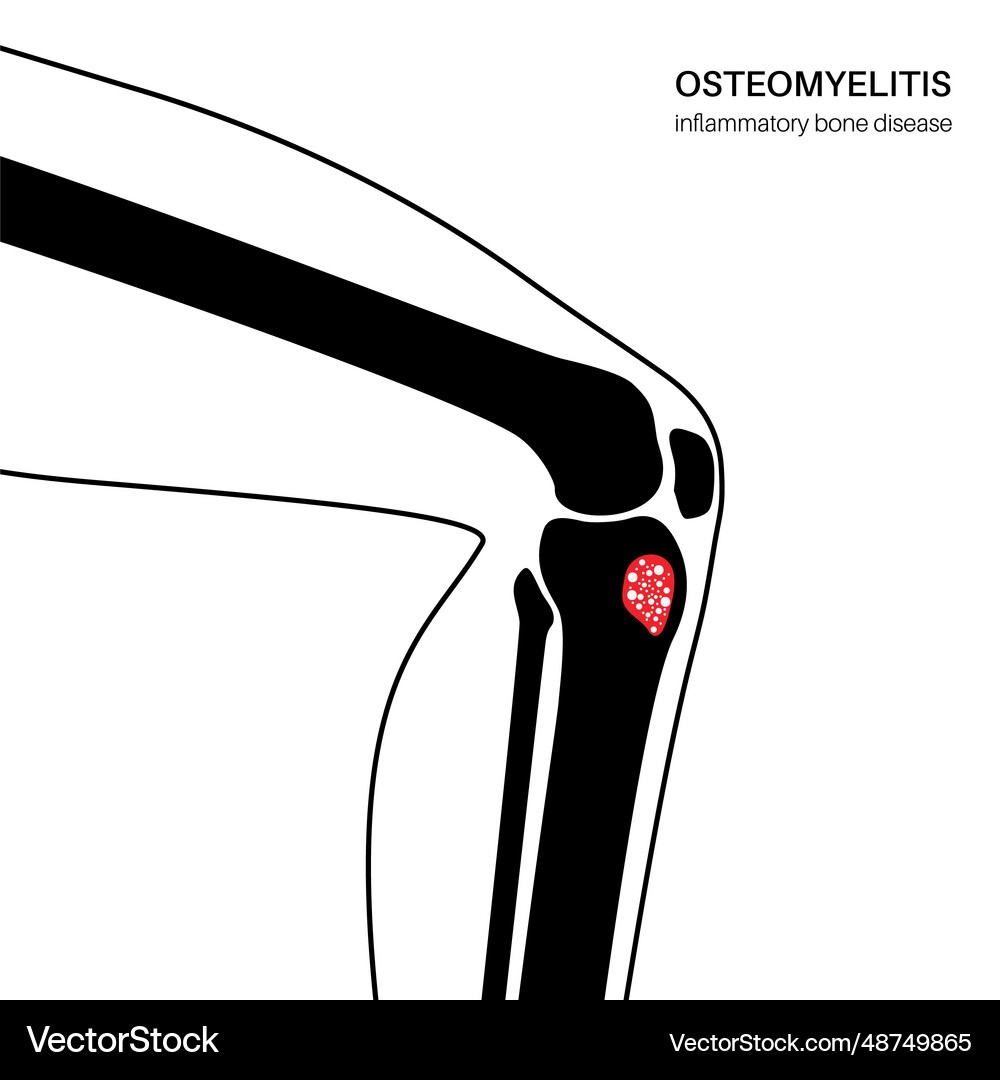 Tibia bone osteomyelitis Royalty Free Vector Image