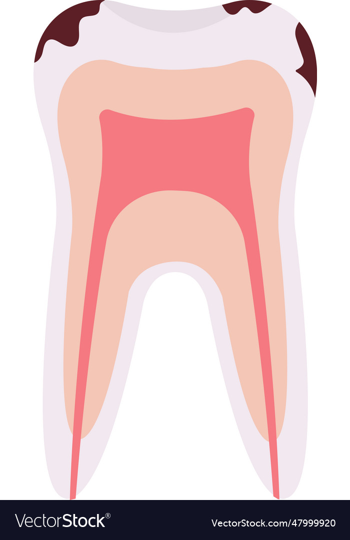 Caries tooth problem Royalty Free Vector Image