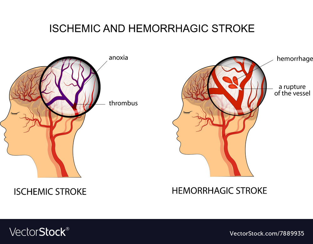 Ischemic And Hemorrhagic Stroke Royalty Free Vector Image