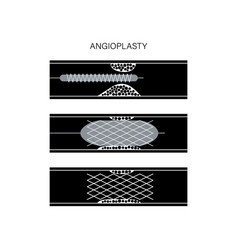 Stent Vector Images (98)