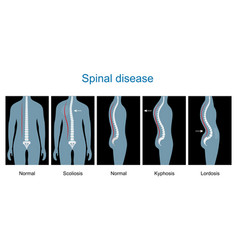 Normal disc and spinal disc herniation Royalty Free Vector