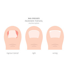 Nail diseases onychocryptocosis ingrown toenail Vector Image