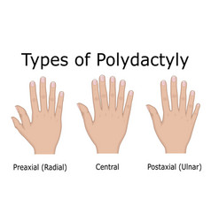 Types polydactyly Royalty Free Vector Image - VectorStock