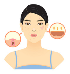 Pimple Royalty Free Vector Image - VectorStock