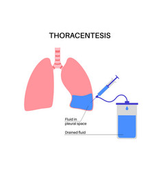 Thoracentesis medical procedure Royalty Free Vector Image