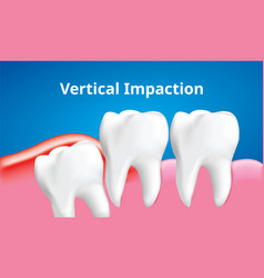 Wisdom tooth vertical impaction Royalty Free Vector Image