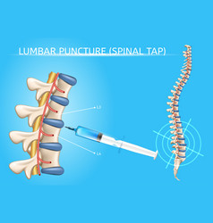 Lumbar puncture realistic medical scheme Vector Image